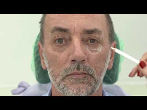 Come eliminare i solchi sotto gli occhi - Farmacia Savonuzzi